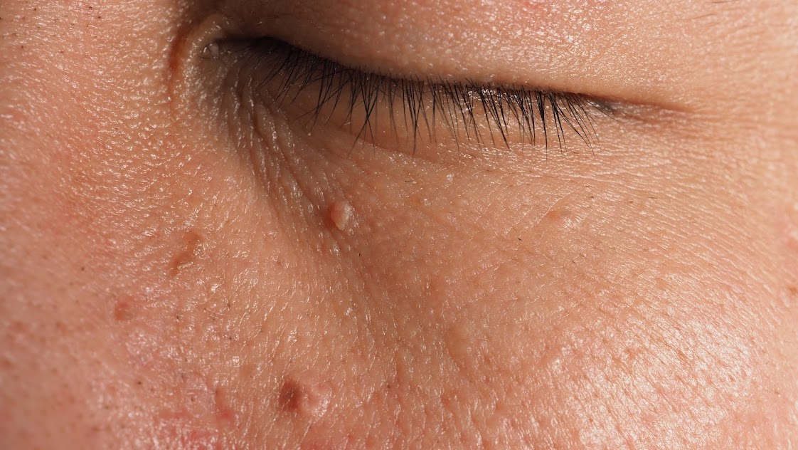 Skin Conditions | Tatyana Ponti, MD